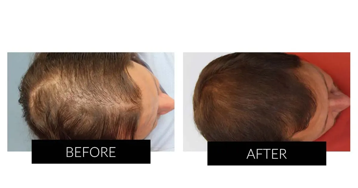 PRP Therapy | TNT Hair Restoration